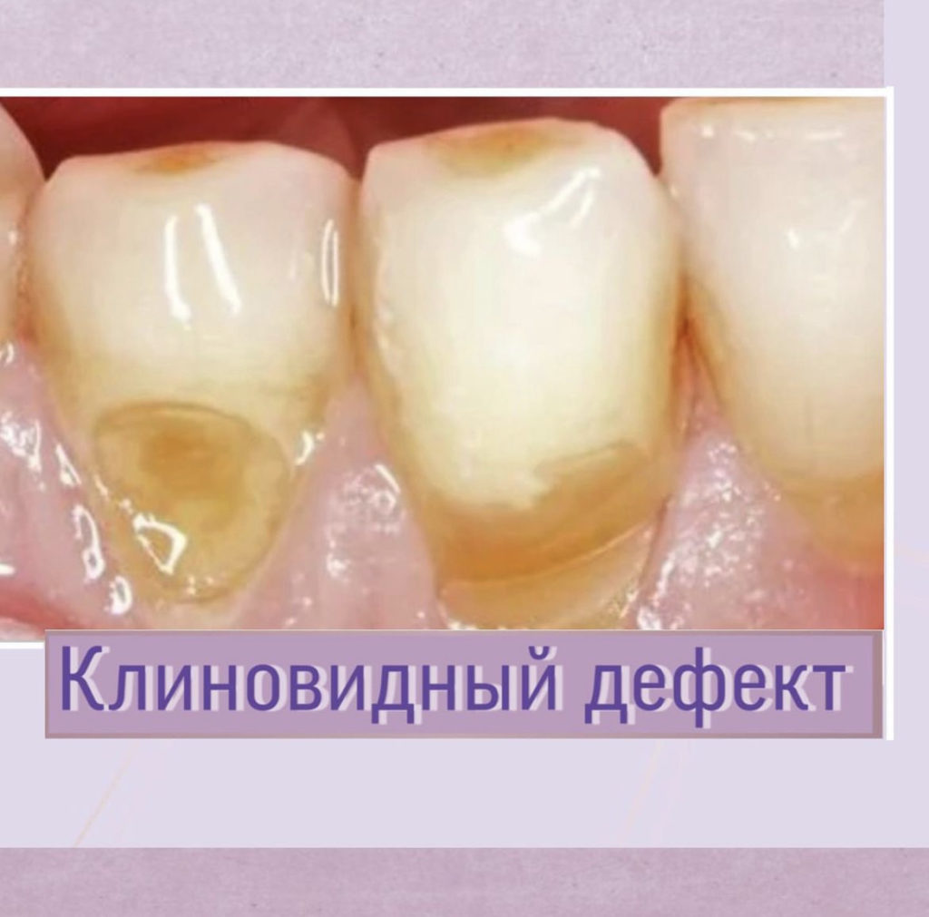 Клиновидный дефект-это что и как лечится? – МИА СМАЙЛ